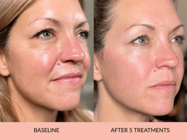 Trilift Facial Treatment Sydney - Book a consultation today!